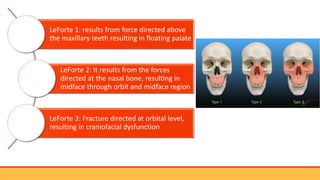 Le Forte Fractures (1).pptx