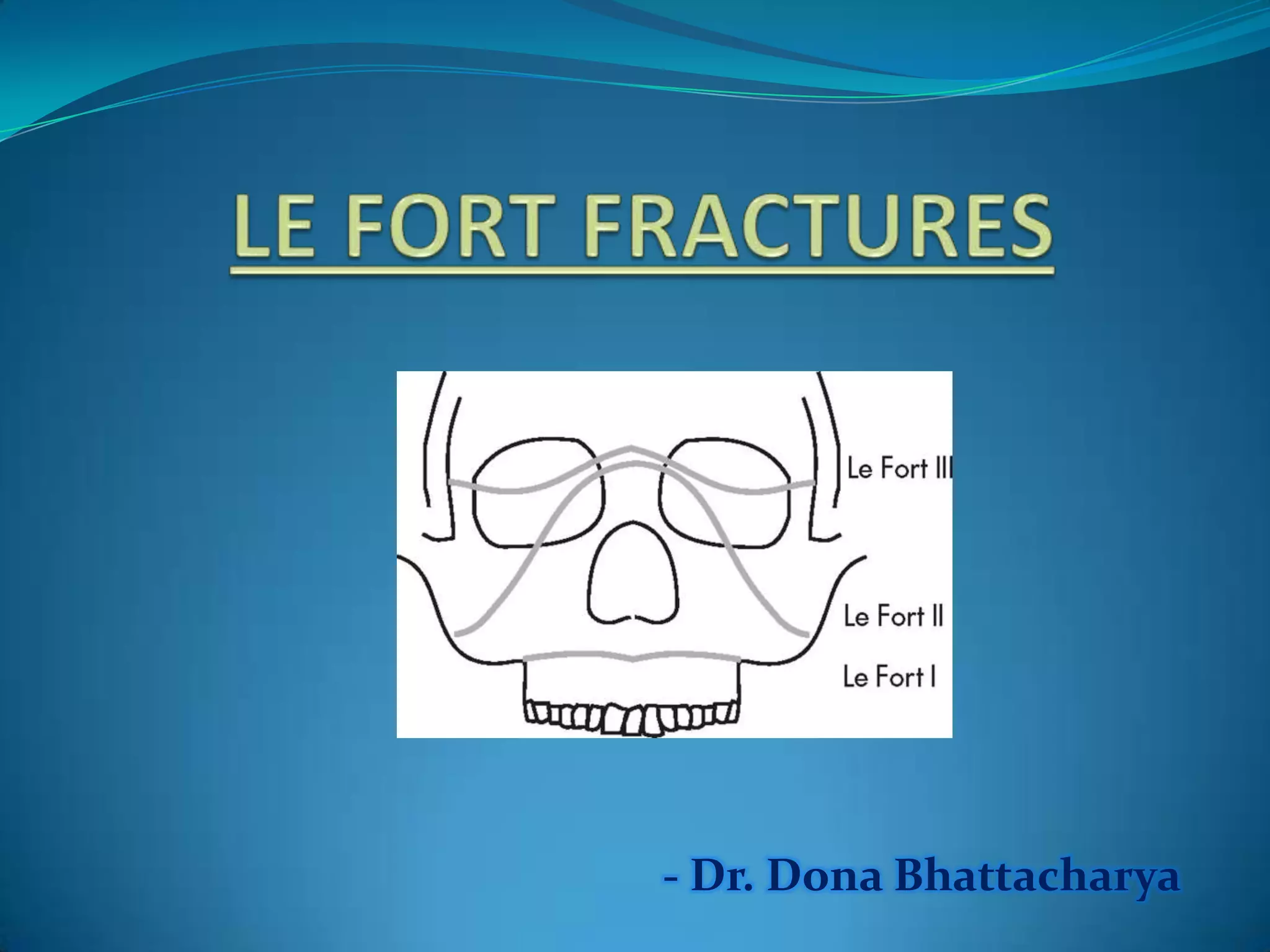 Le fort fracture(2) | PPTX