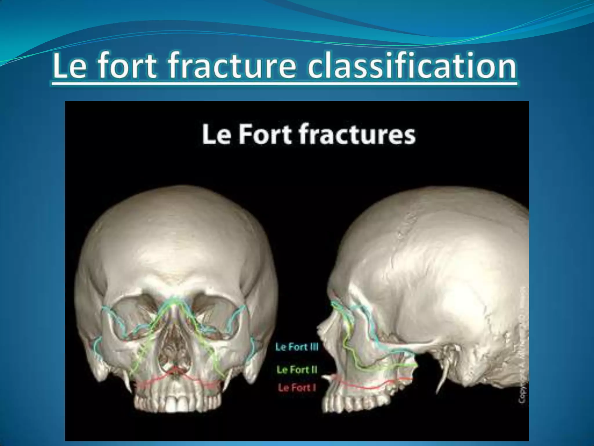 Le fort fracture(2) | PPTX