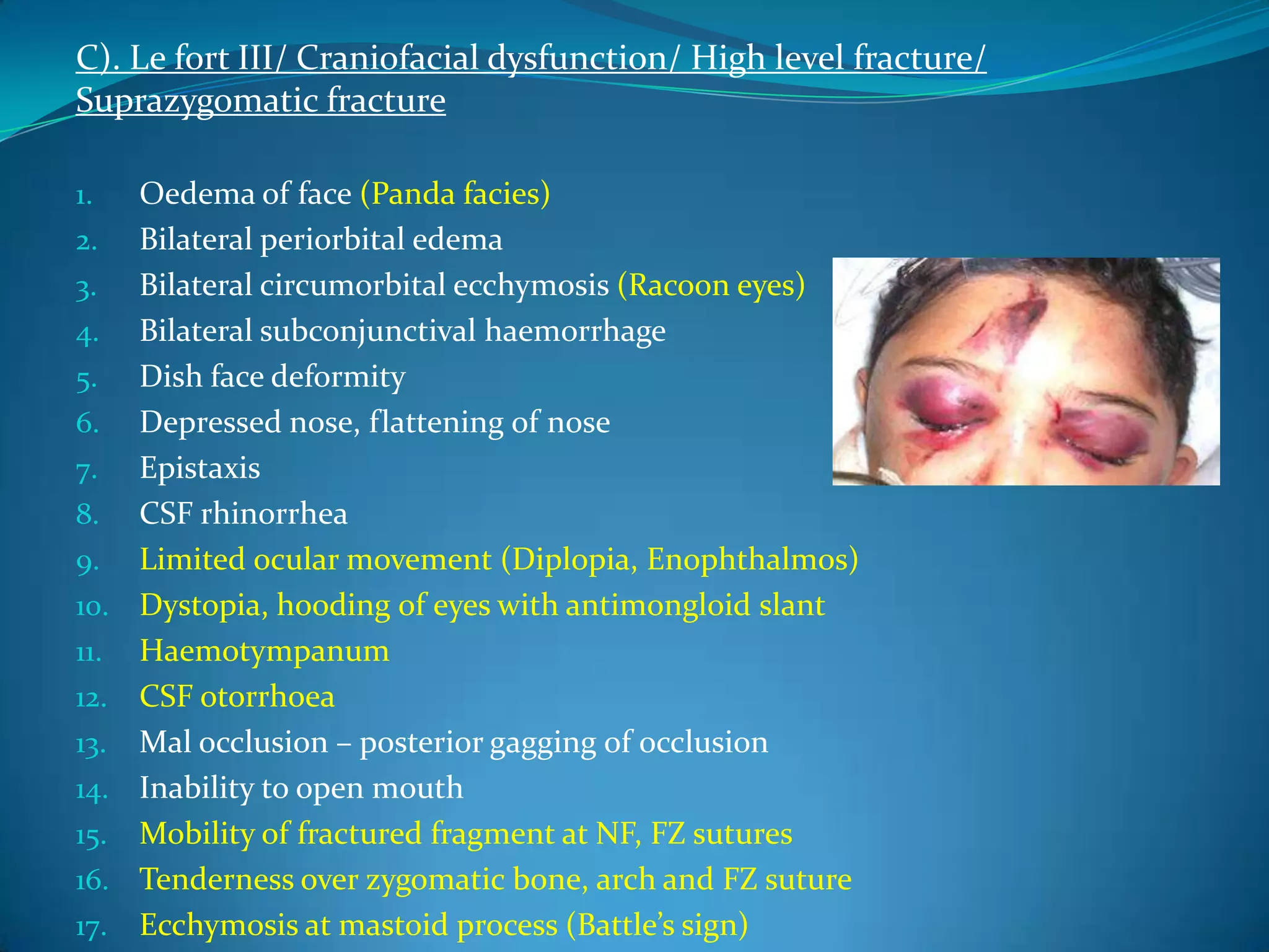Le fort fracture(2) | PPTX