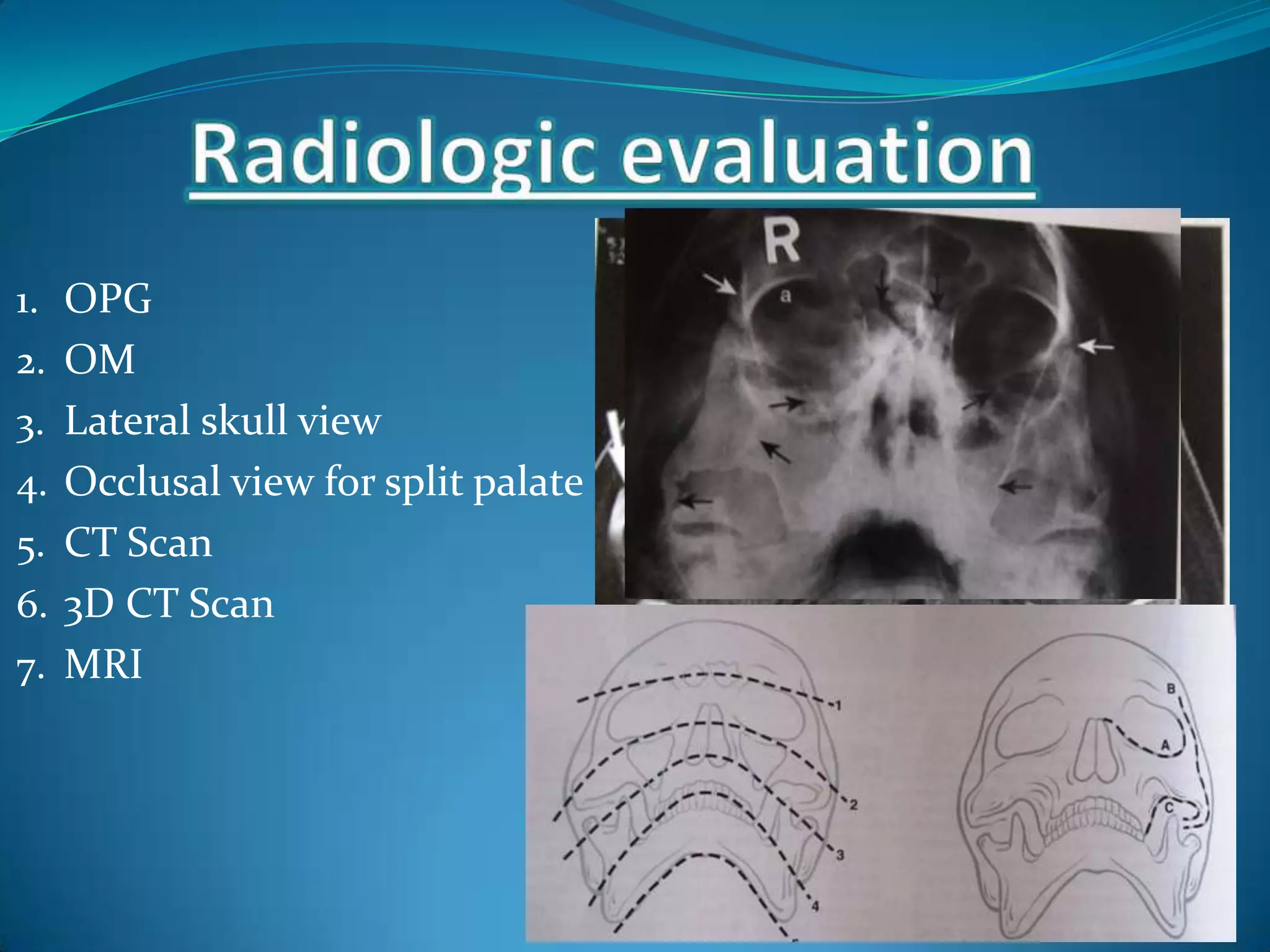 Le fort fracture(2) | PPTX