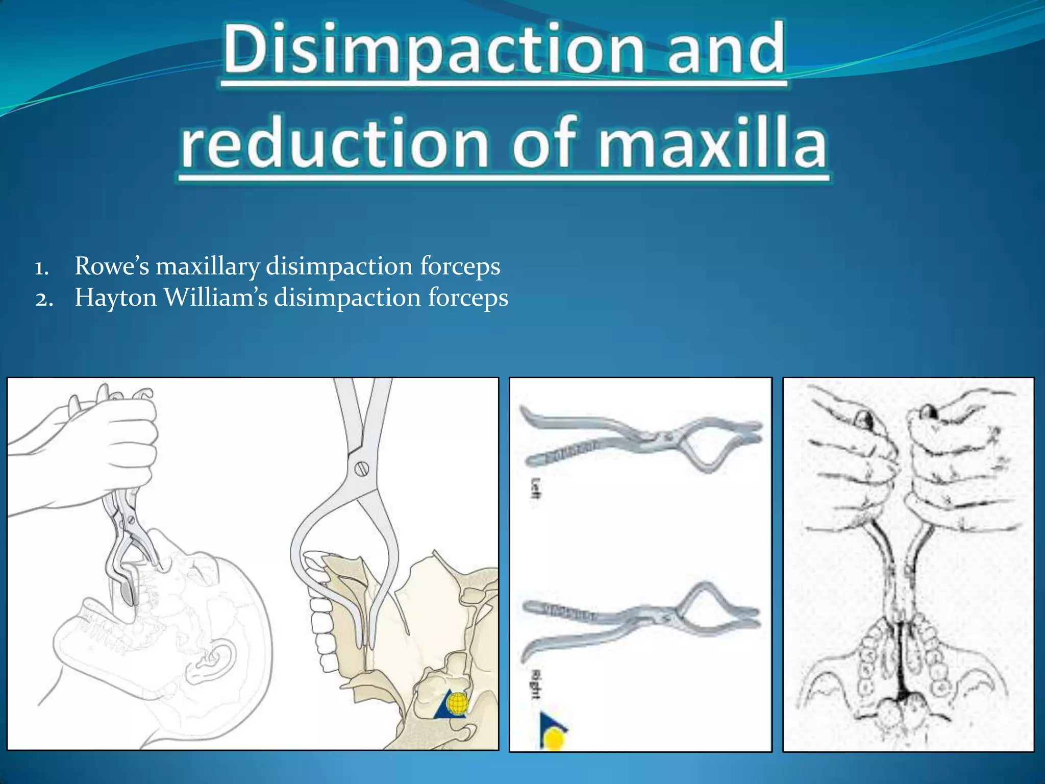 Le fort fracture(2) | PPTX