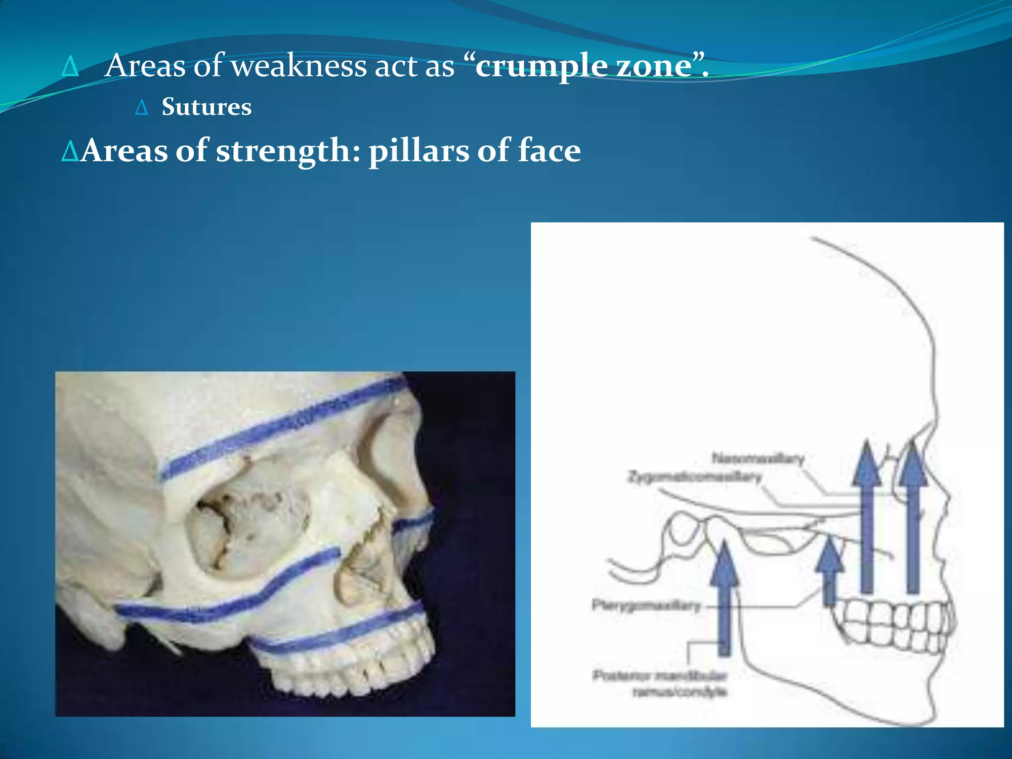 Le fort fracture(2) | PPTX