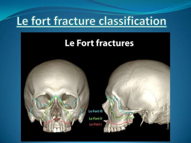 Le fort fracture(2) | PPTX