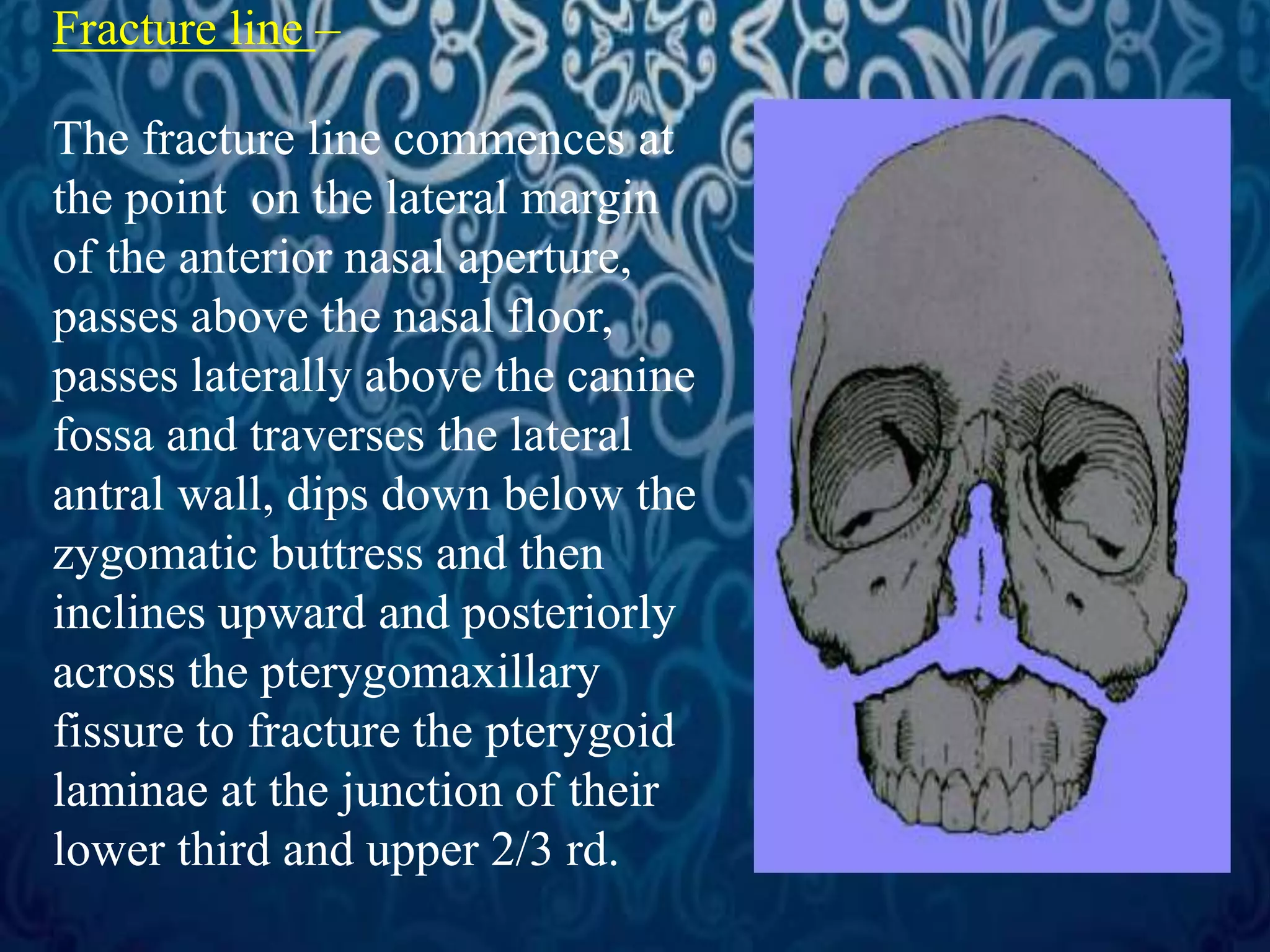 Le fort fracture by Dr. Amit T. Suryawanshi, Oral Surgeon, Pune | PPTX
