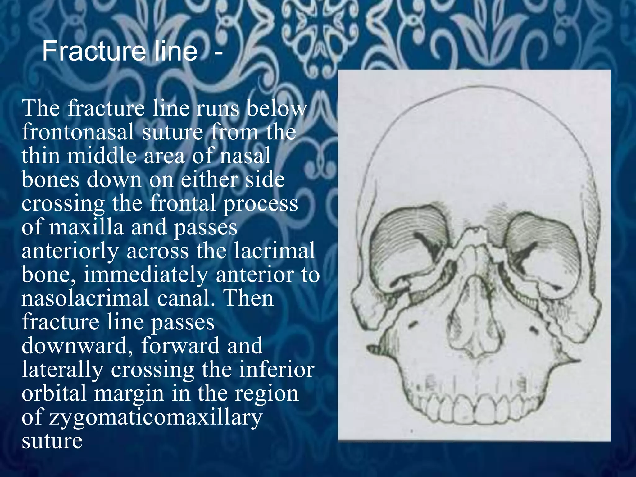 Le fort fracture by Dr. Amit T. Suryawanshi, Oral Surgeon, Pune | PPTX
