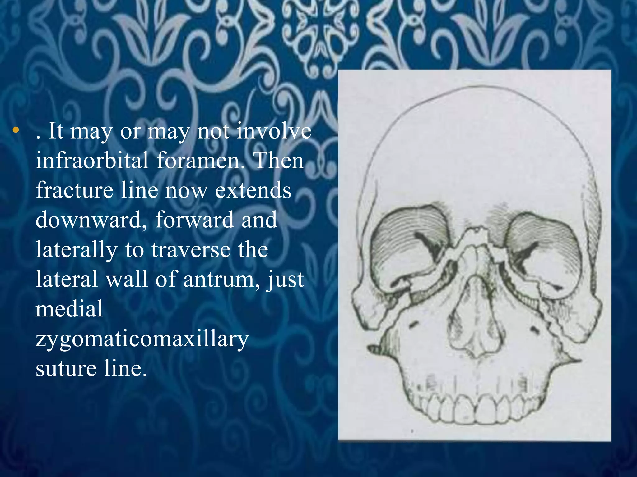 Le fort fracture by Dr. Amit T. Suryawanshi, Oral Surgeon, Pune | PPTX