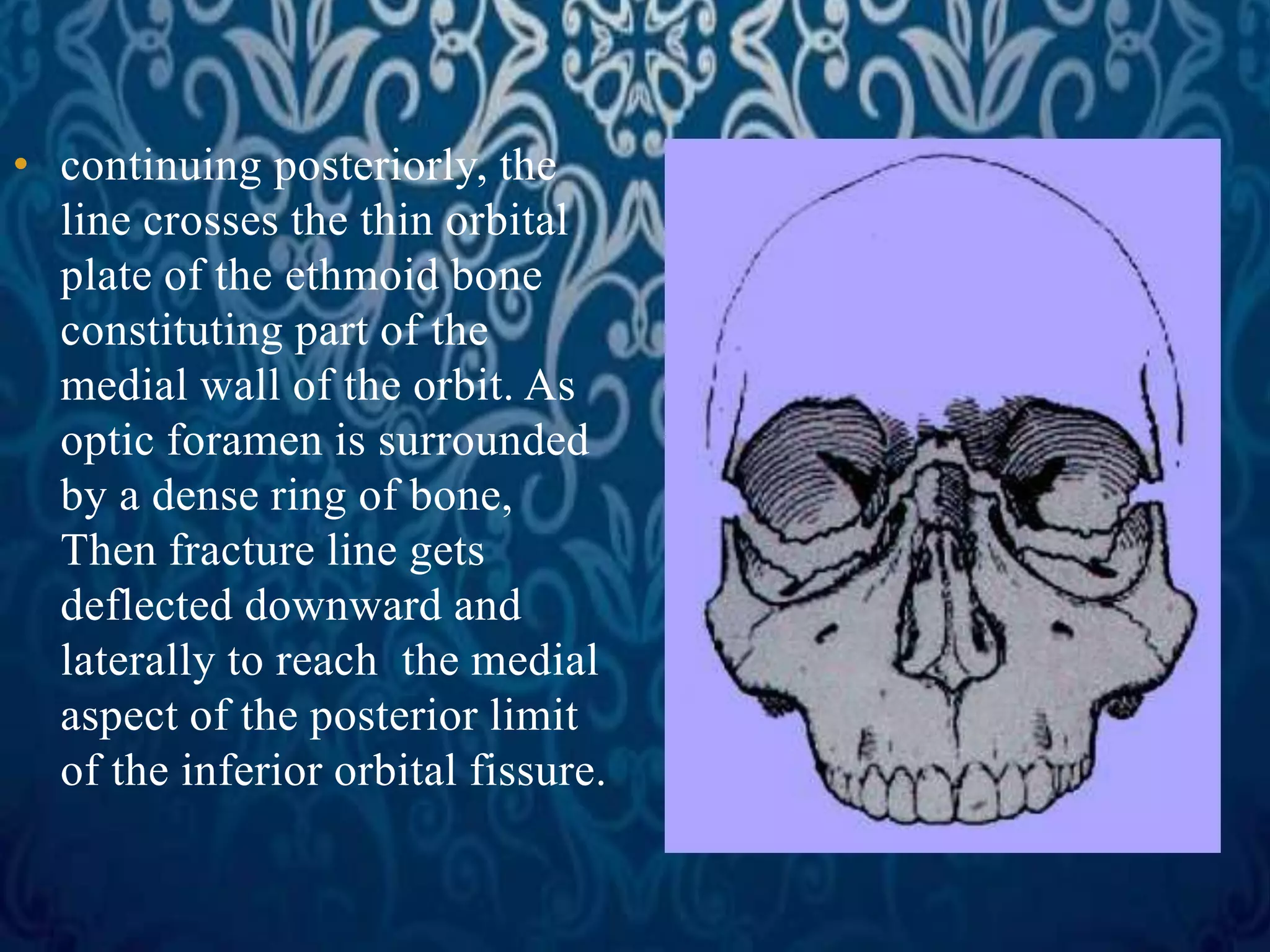 Le fort fracture by Dr. Amit T. Suryawanshi, Oral Surgeon, Pune | PPTX