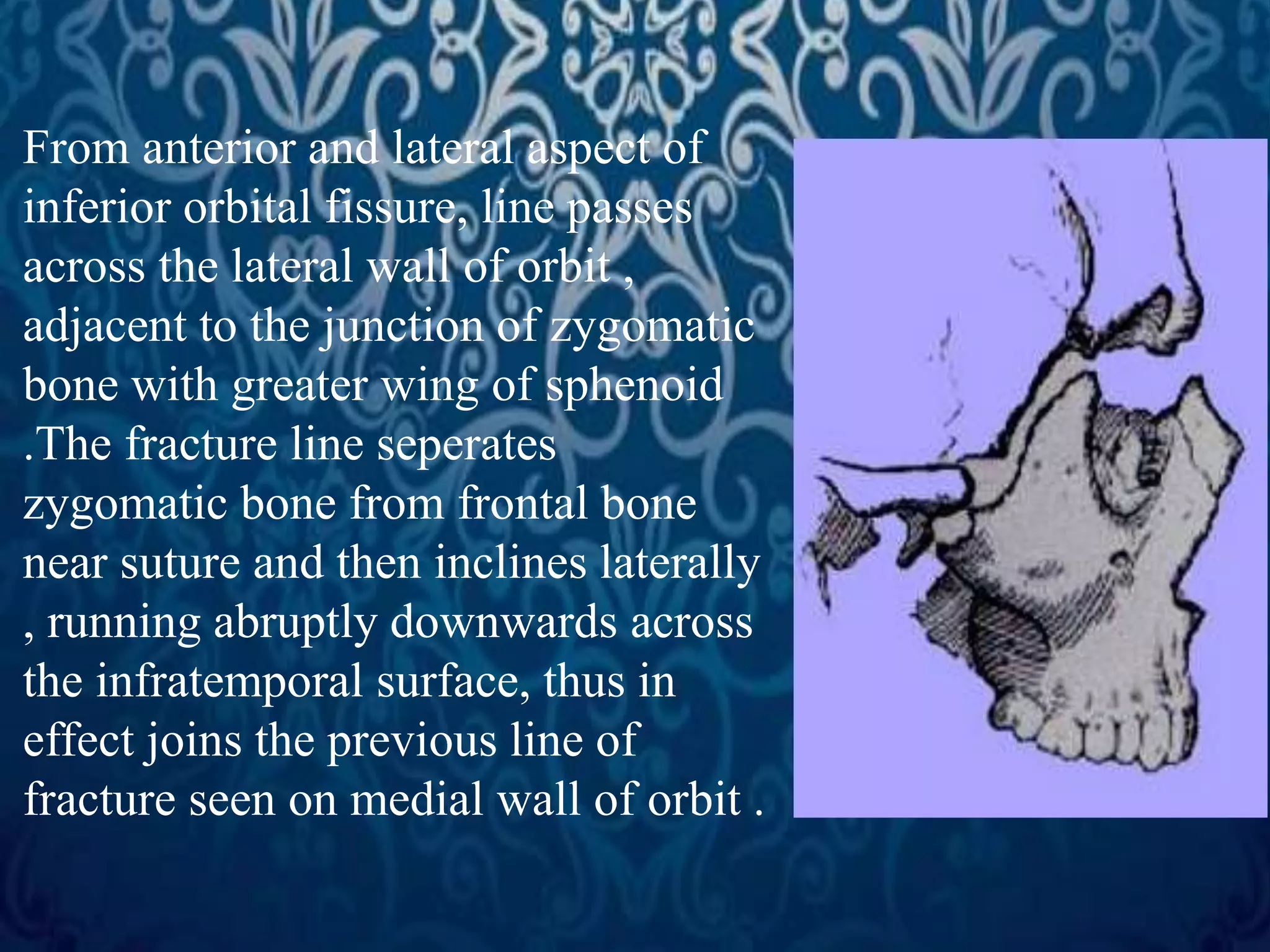 Le fort fracture by Dr. Amit T. Suryawanshi, Oral Surgeon, Pune | PPTX