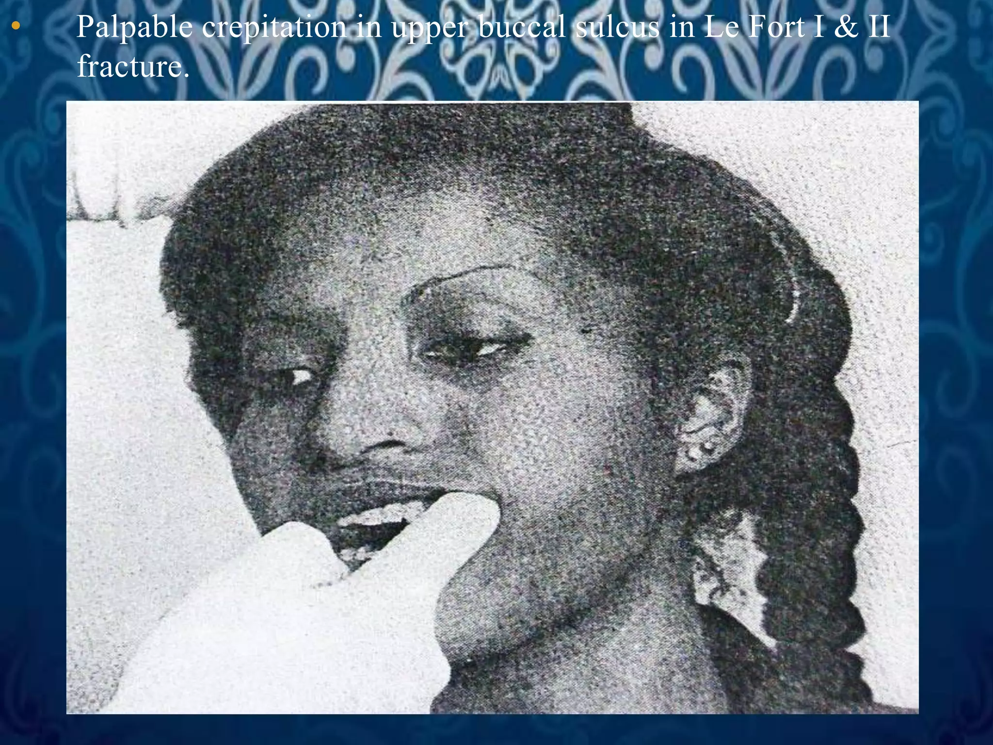 Le fort fracture by Dr. Amit T. Suryawanshi, Oral Surgeon, Pune | PPTX