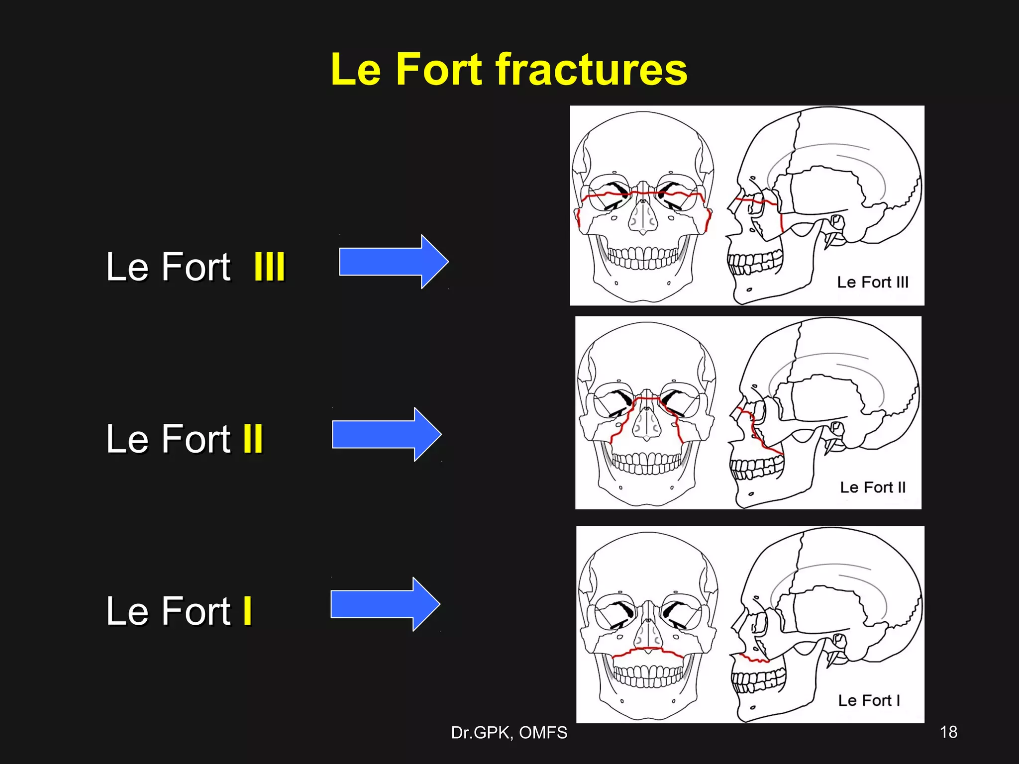 Le fort fractures | PPT