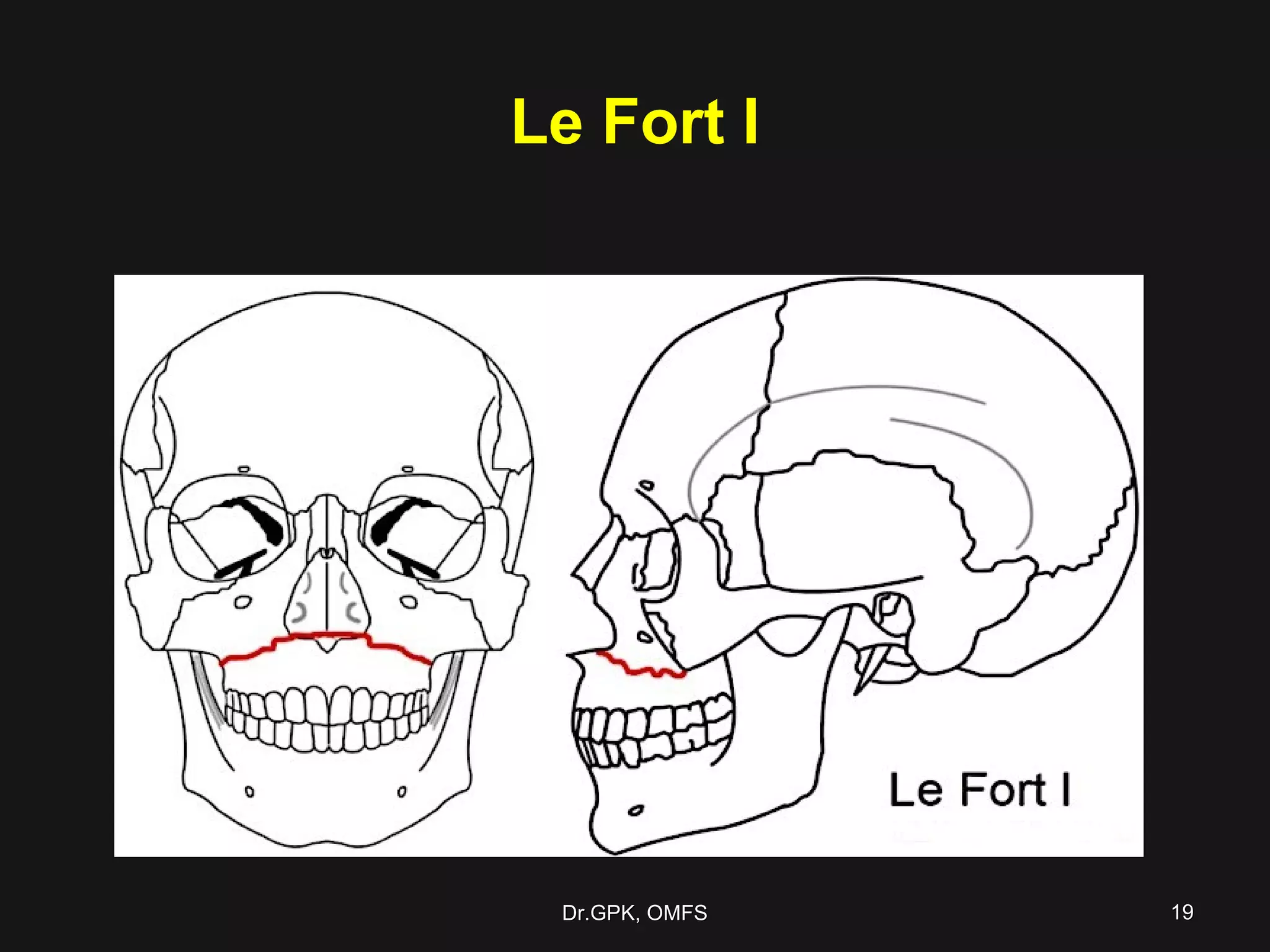Le fort fractures | PPT