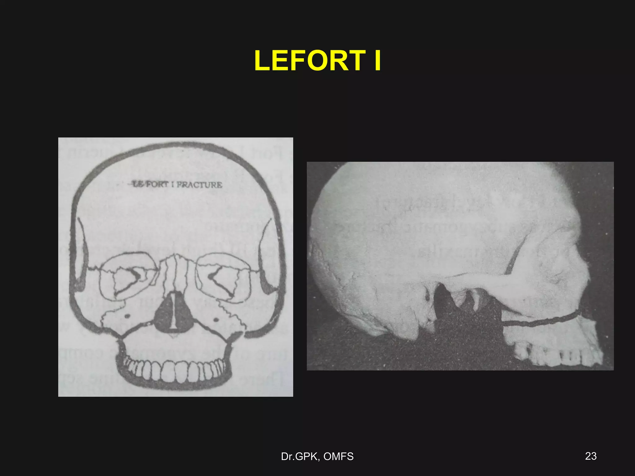 Le fort fractures | PPT