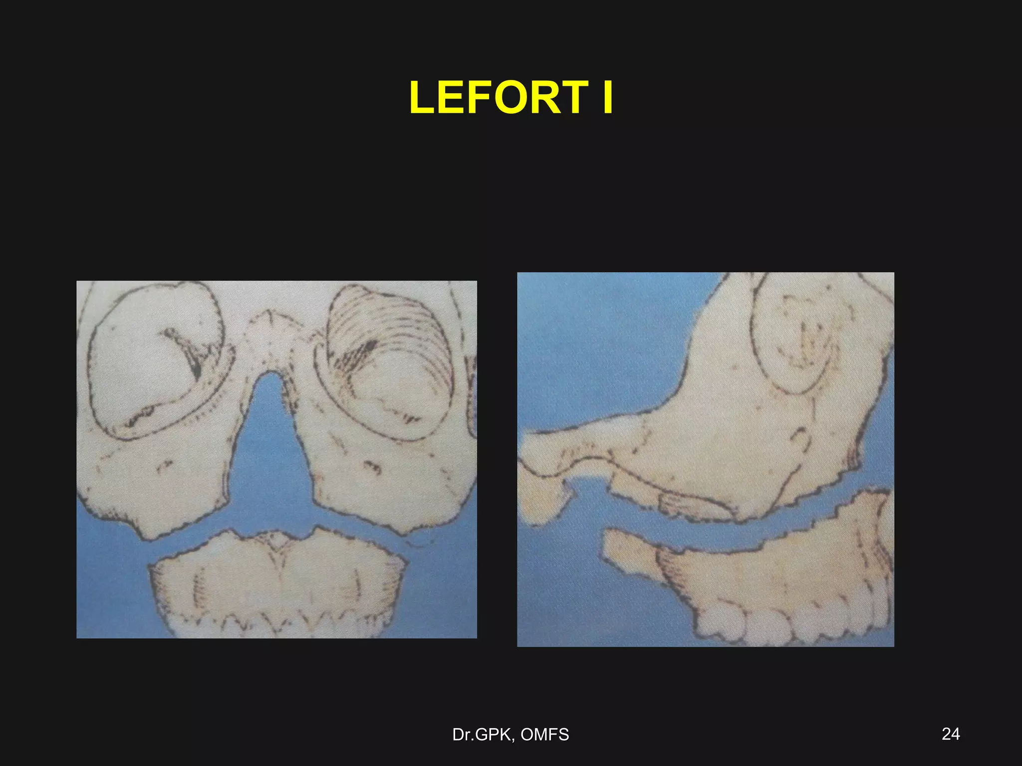 Le fort fractures | PPT