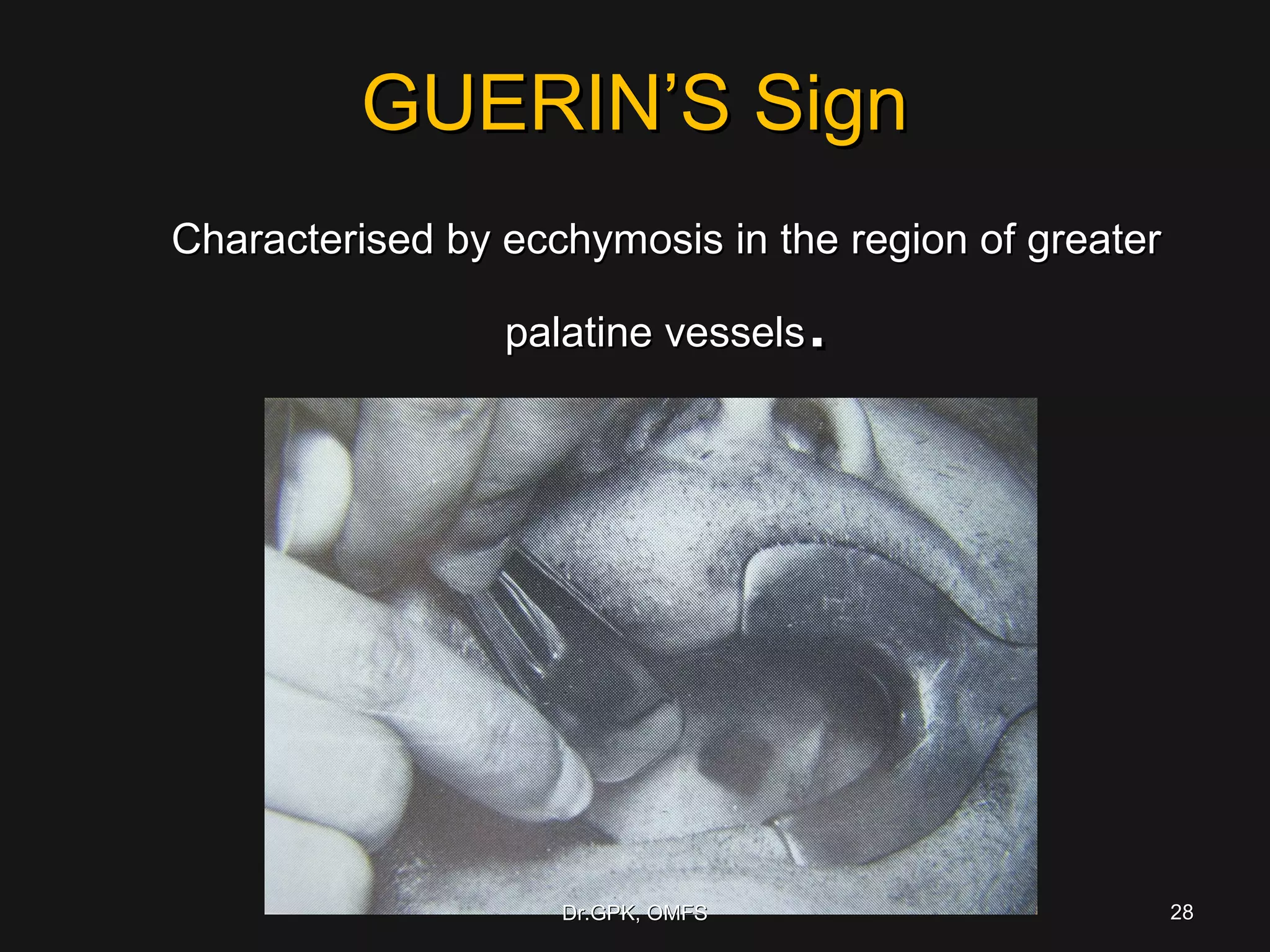 Le fort fractures | PPT