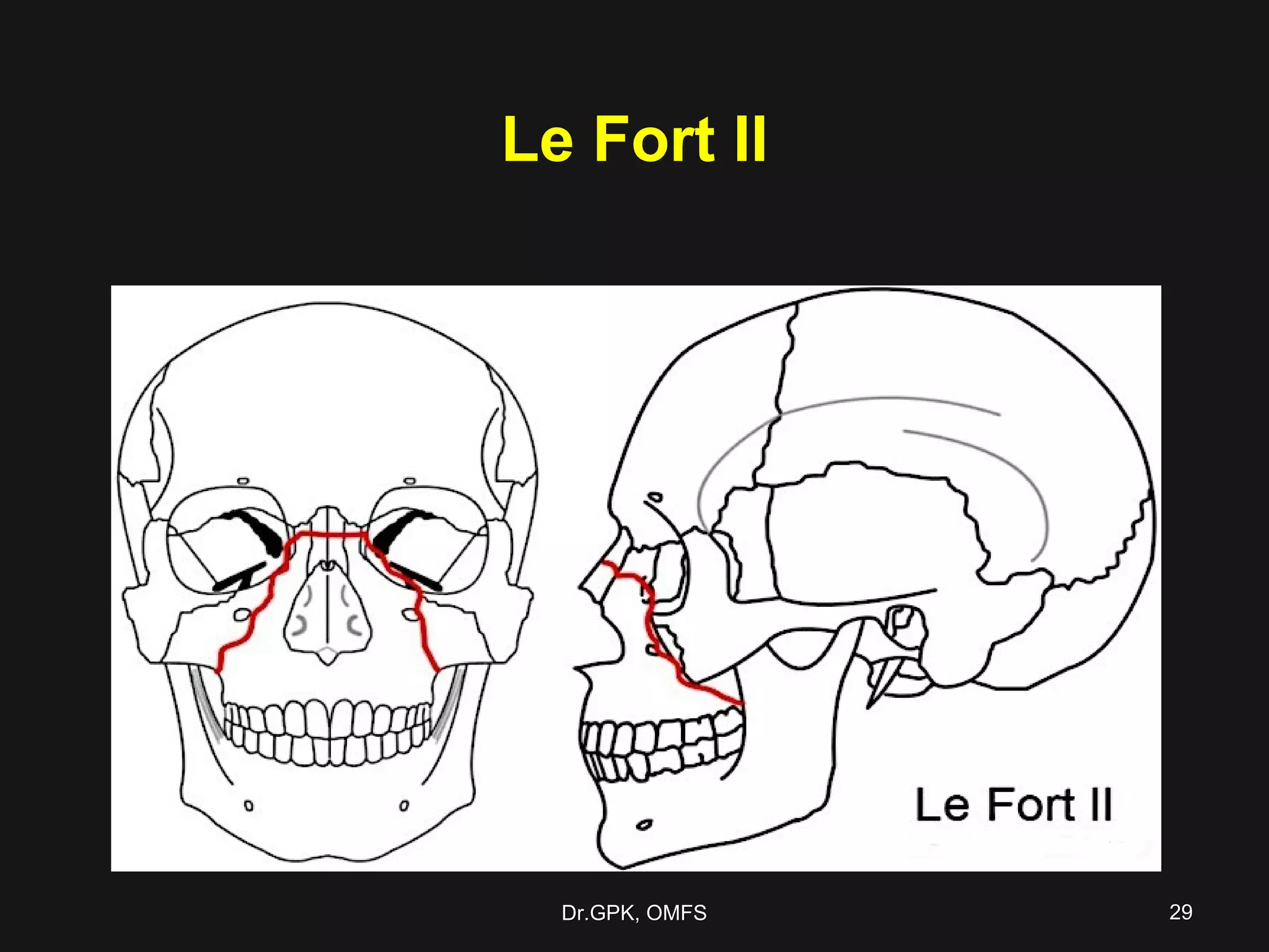 Le fort fractures | PPT