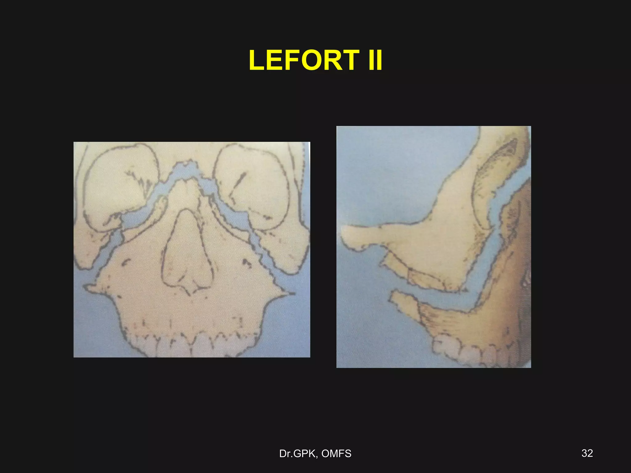 Le fort fractures | PPT