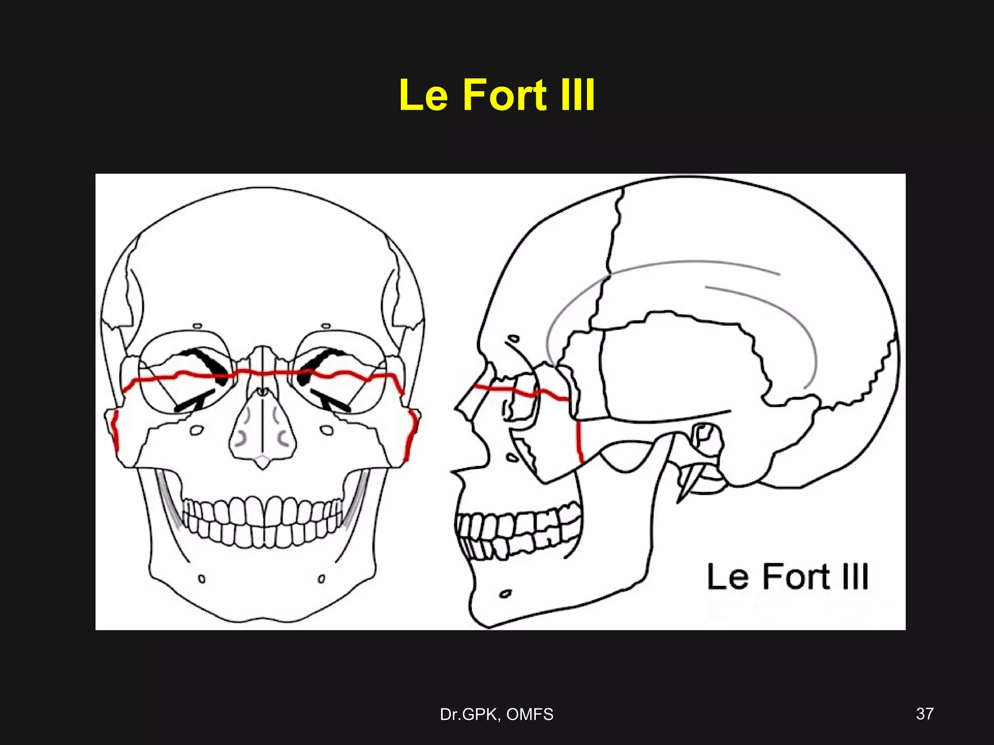 Le fort fractures | PPT