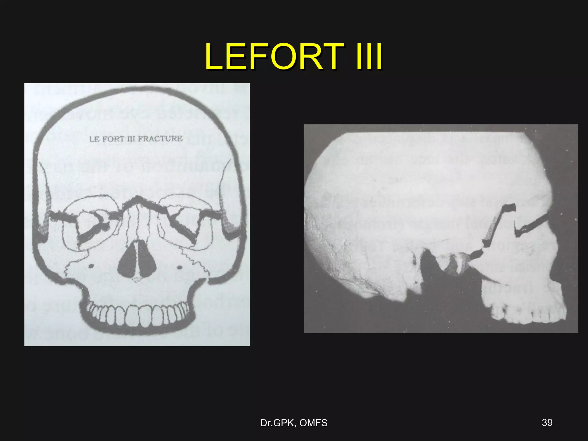Le fort fractures | PPT