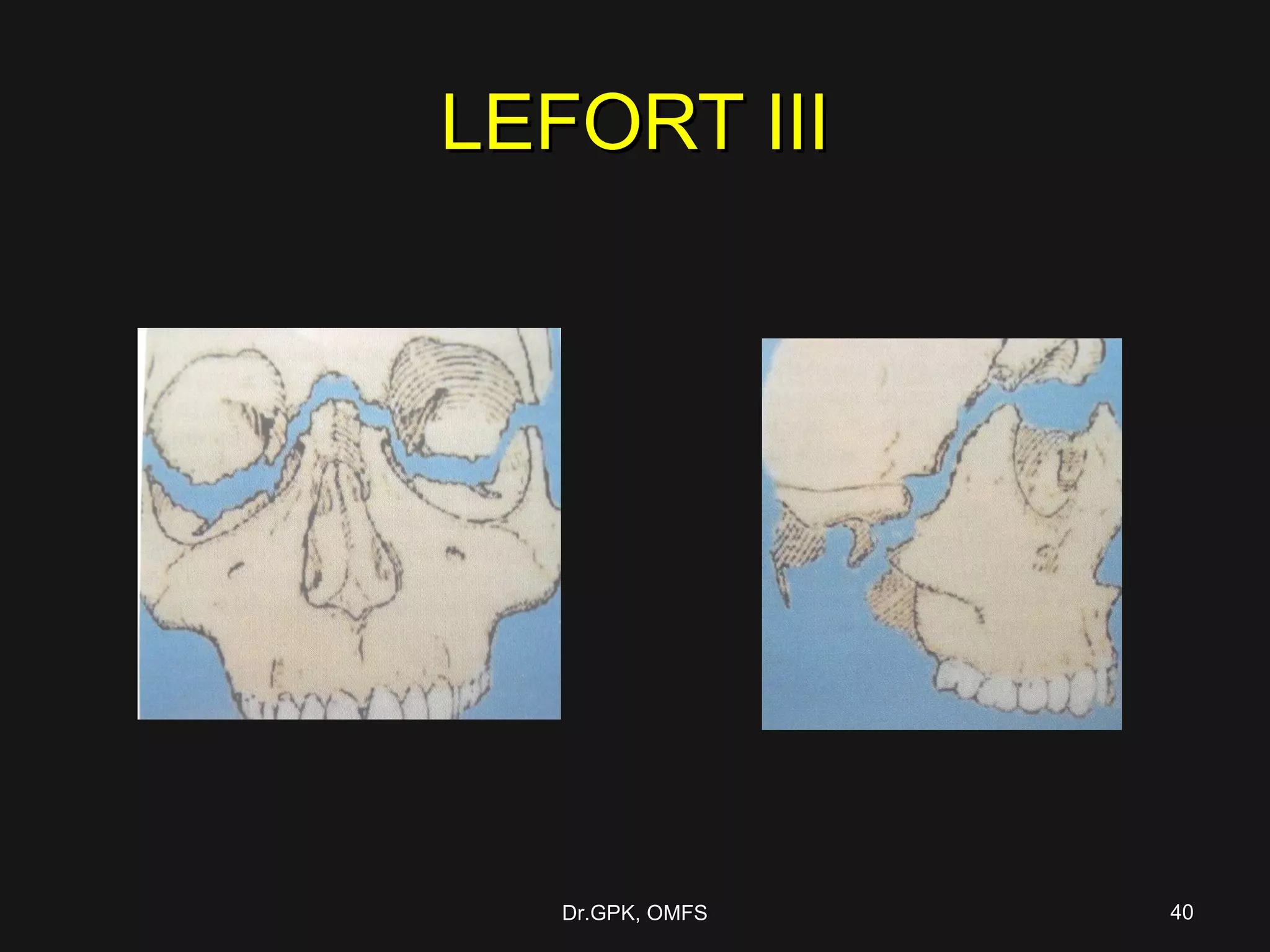 Le fort fractures | PPT