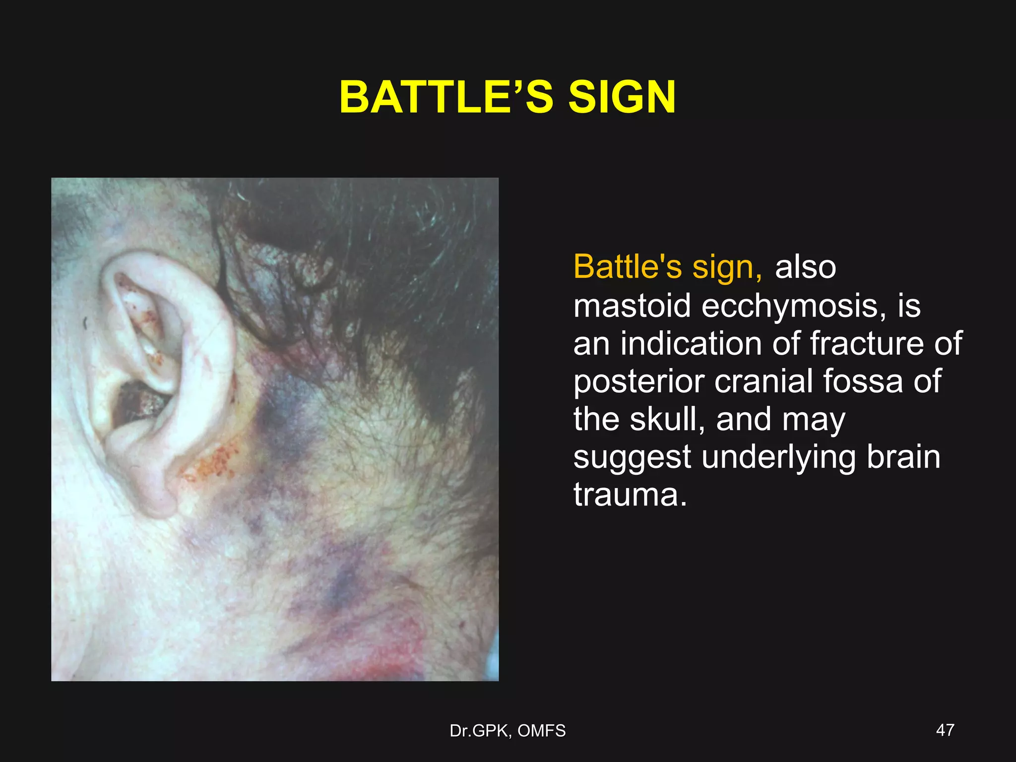 Le fort fractures | PPT