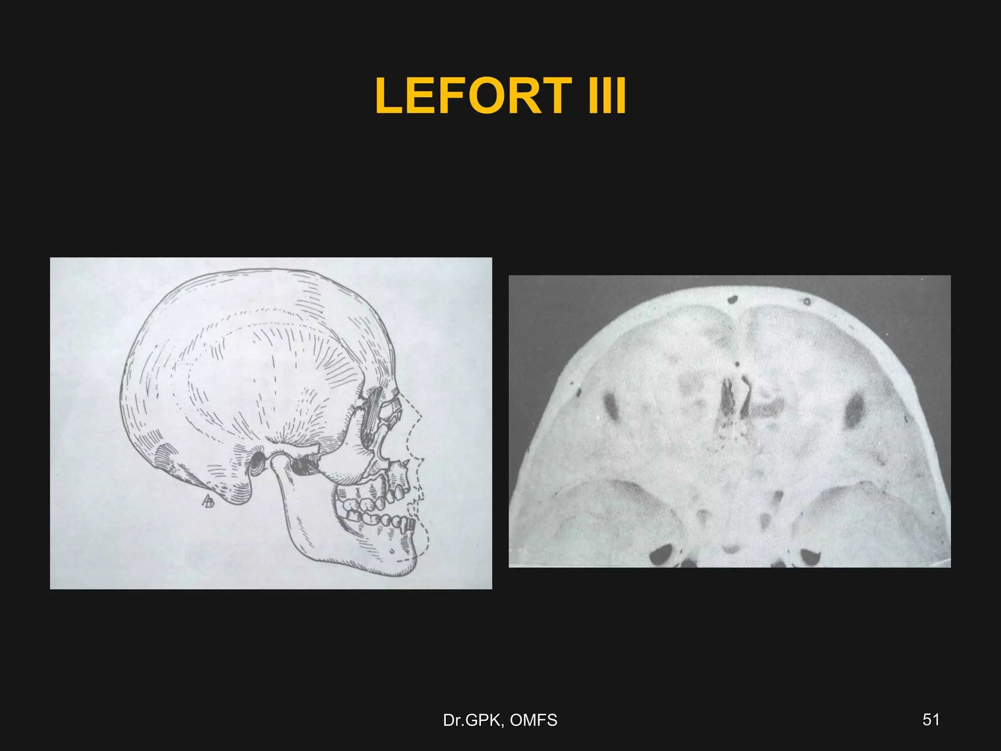 Le fort fractures | PPT
