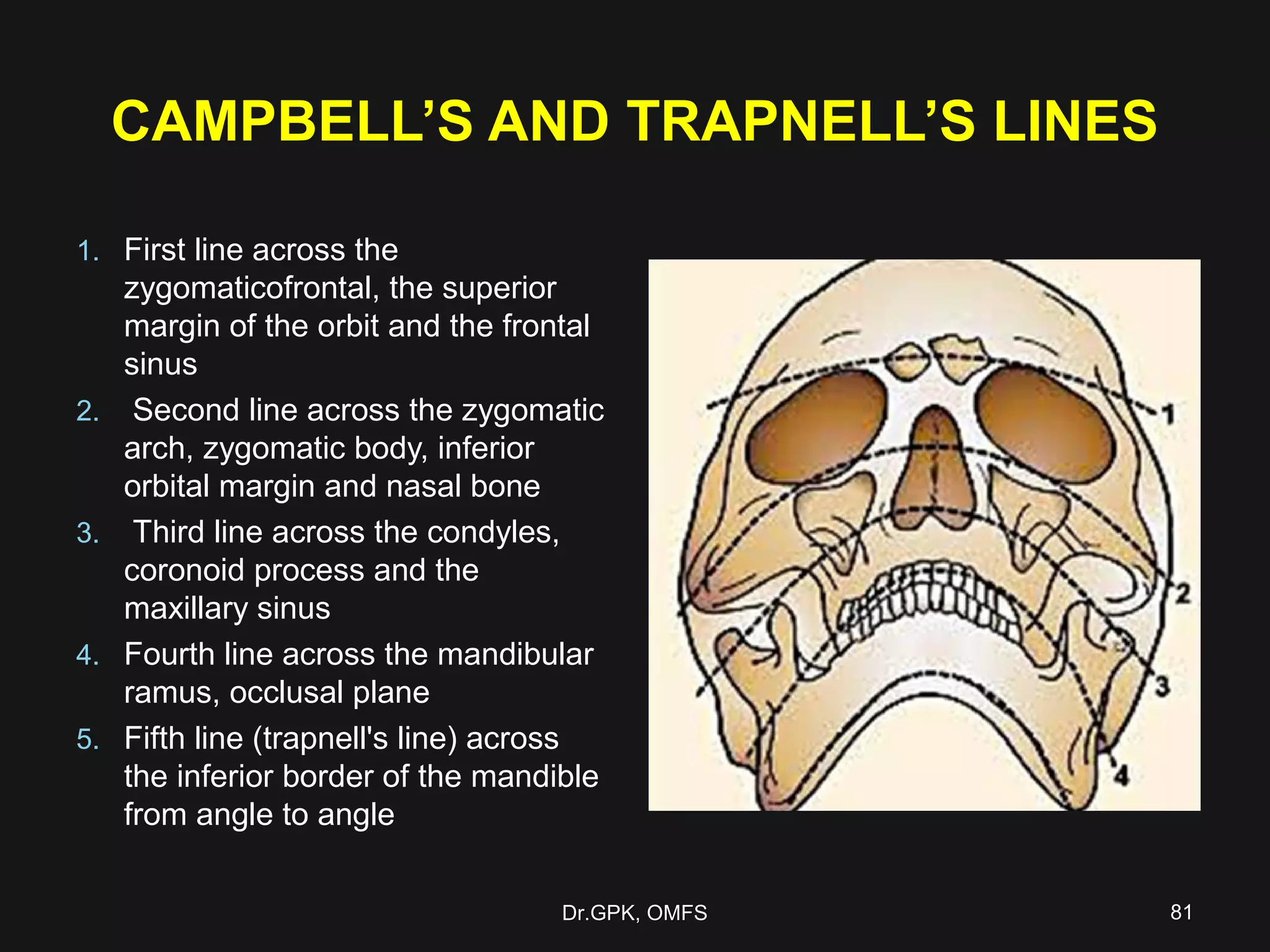 Le fort fractures | PPT