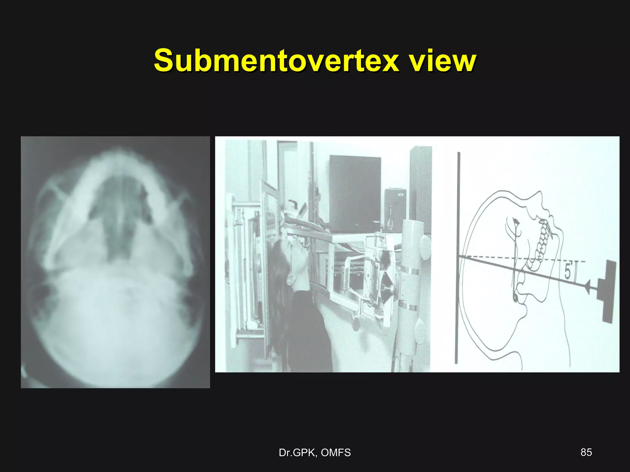 Le fort fractures | PPT