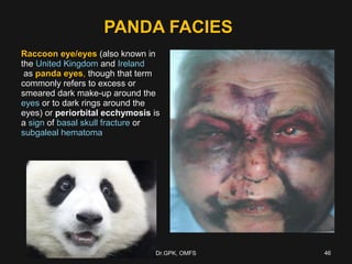 Le fort fractures | PPT