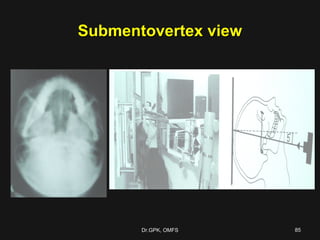 Le fort fractures | PPT