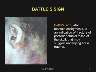 Le fort fractures | PPT