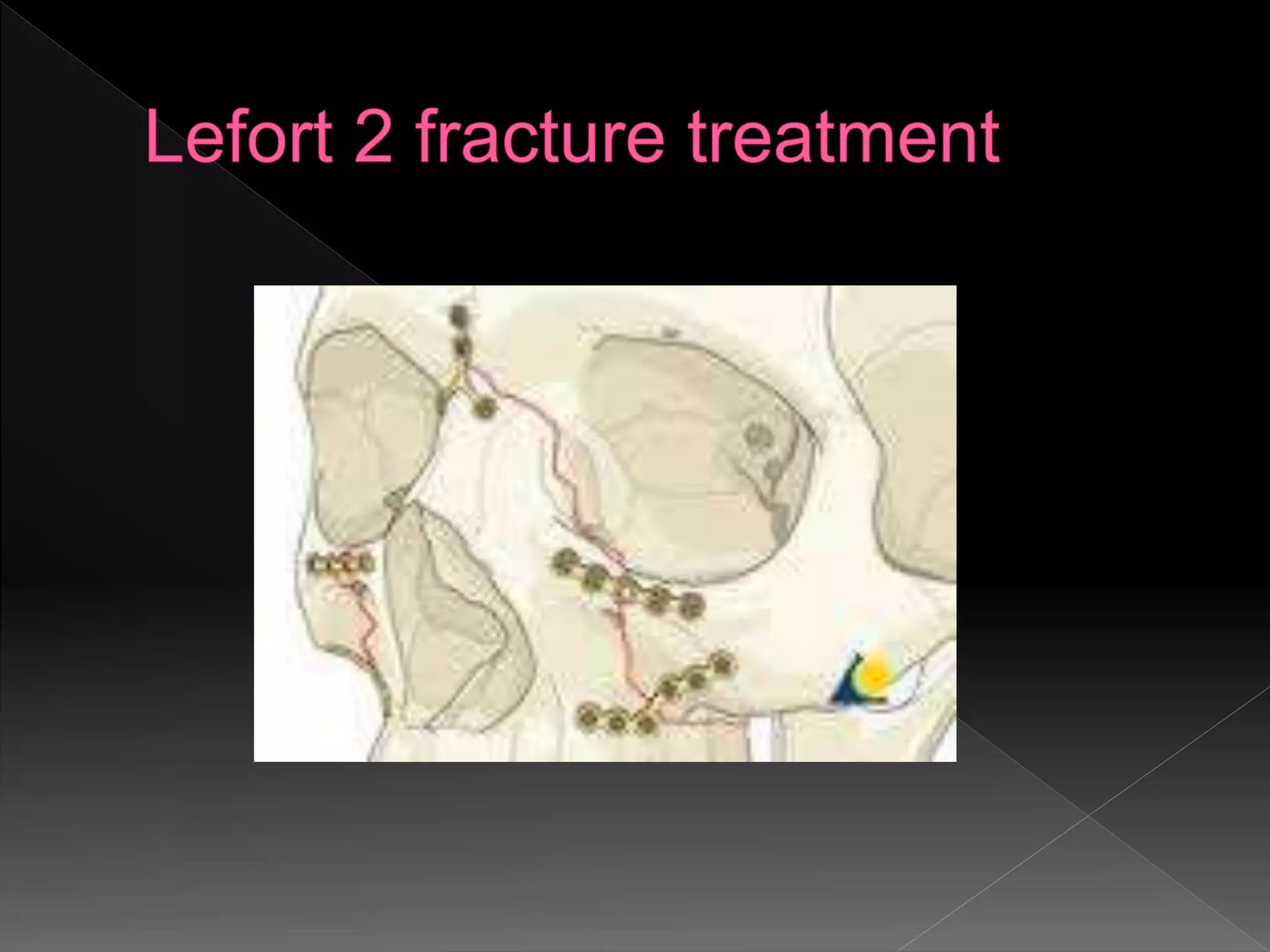 Lefort fractures | PPTX