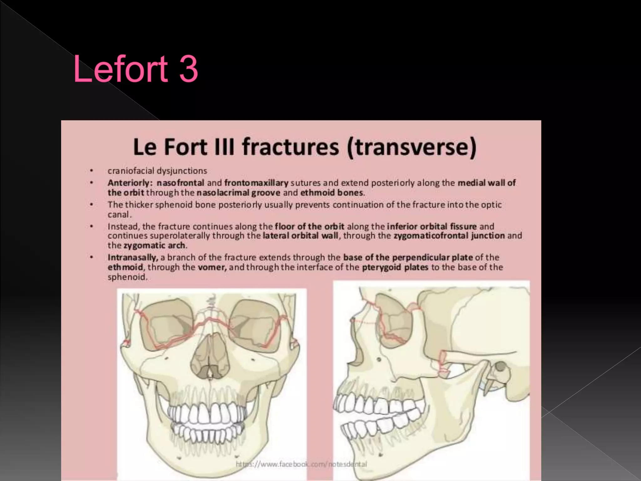 Lefort fractures | PPTX