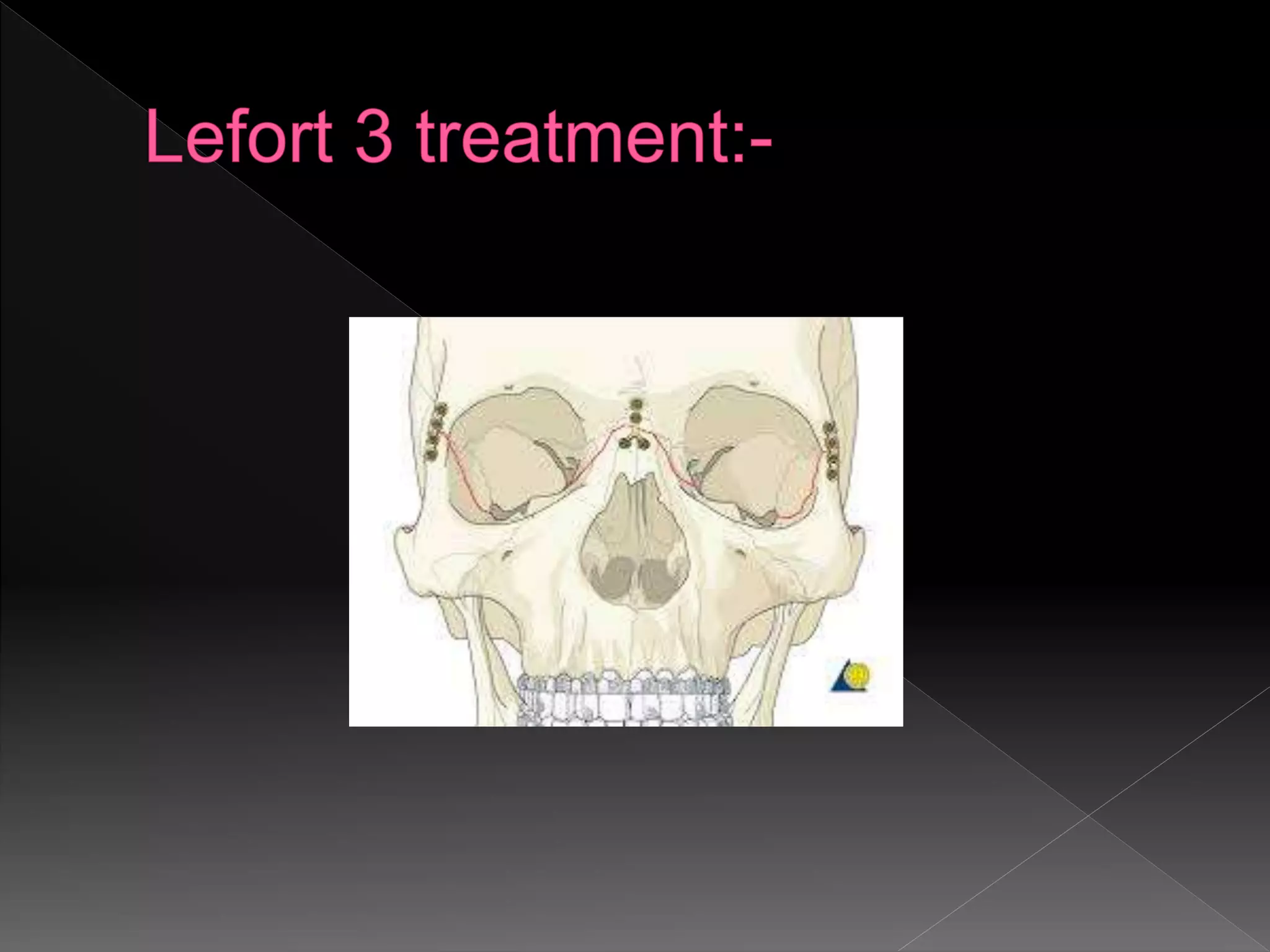Lefort fractures | PPTX