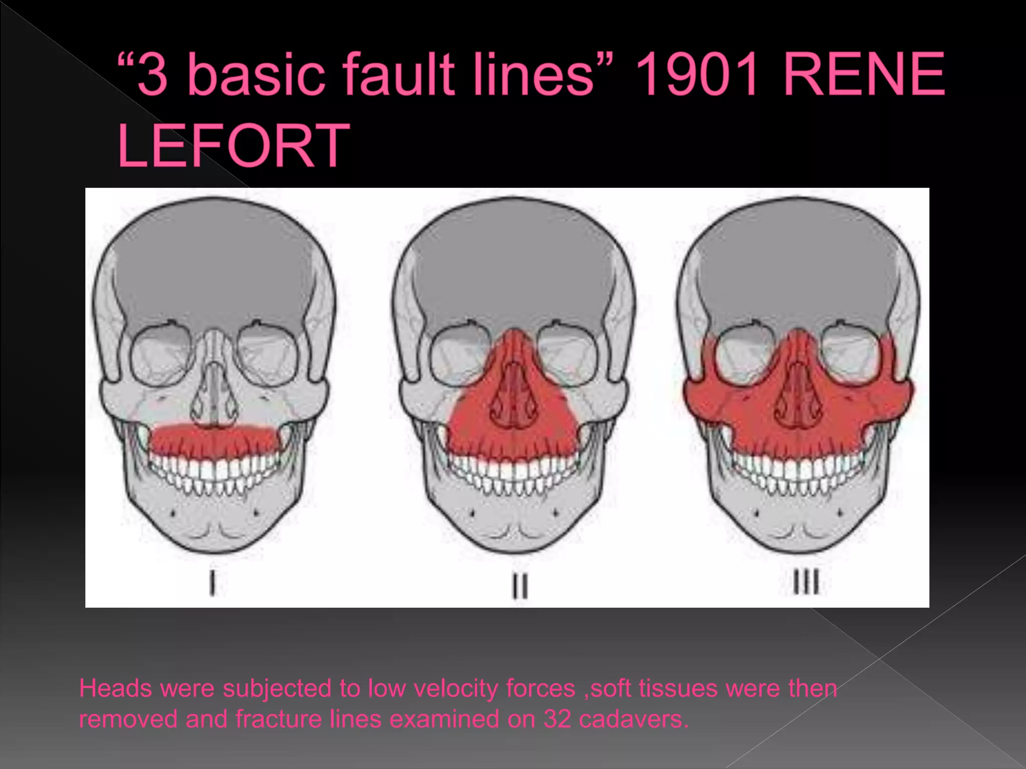 Lefort fractures | PPTX