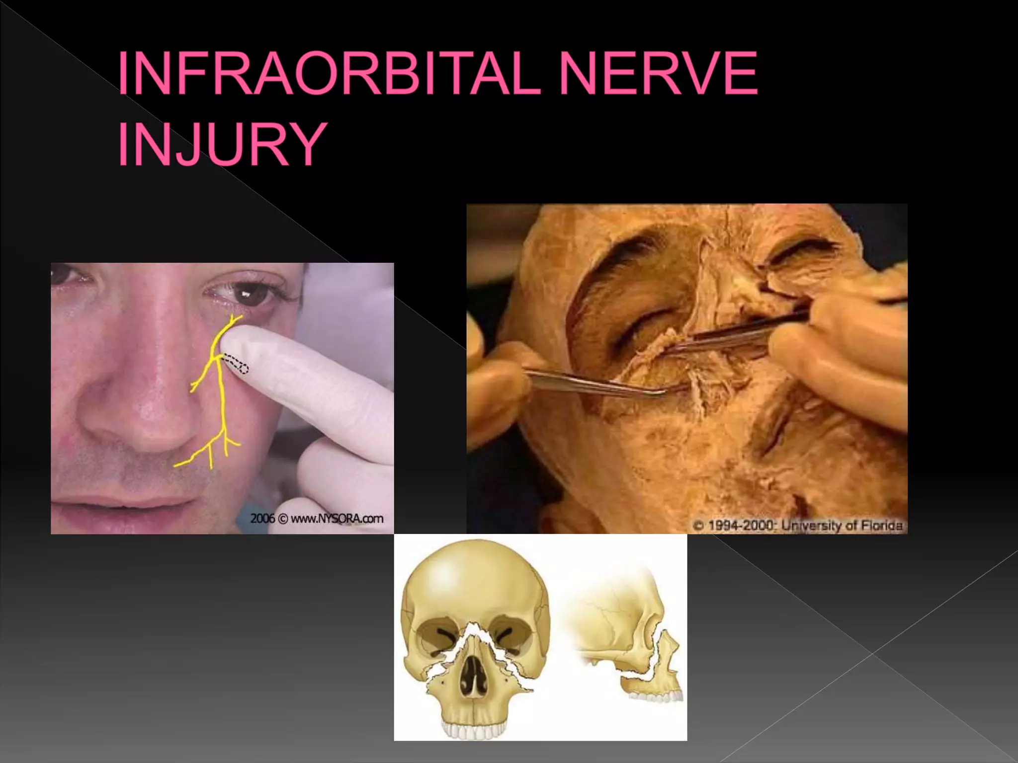 Lefort fractures | PPTX