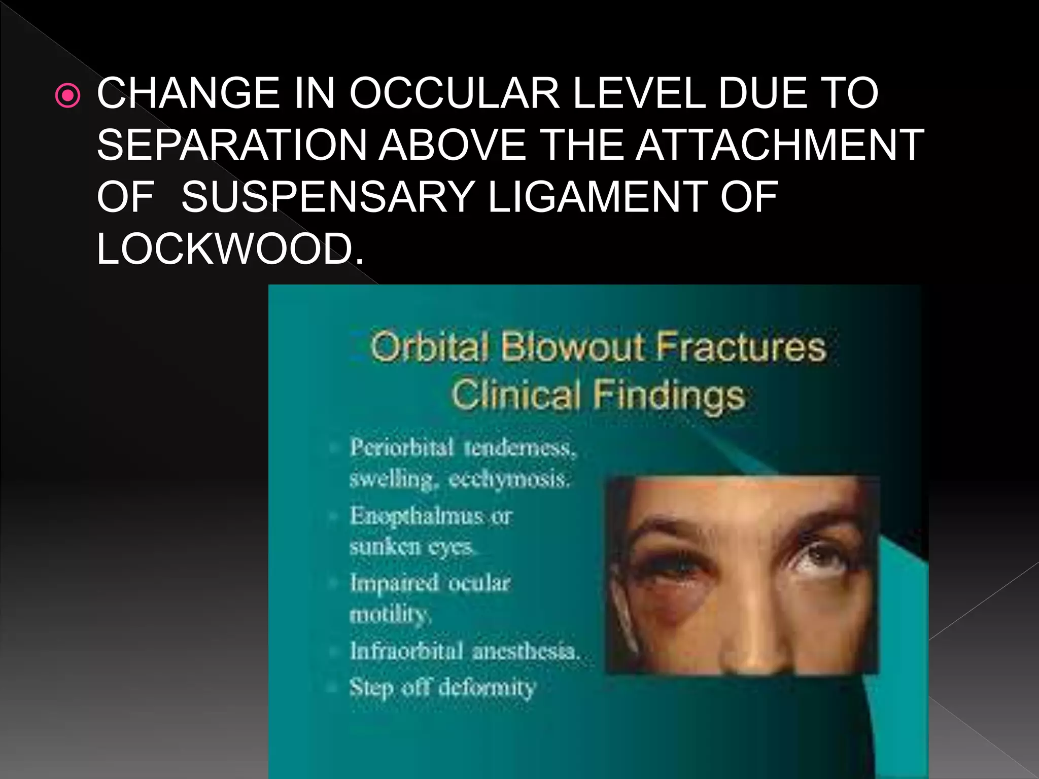 Lefort fractures | PPTX