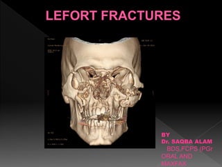 Lefort fractures | PPTX