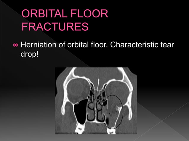 Lefort fractures | PPTX | Death, Injury, or Military Conflict ...