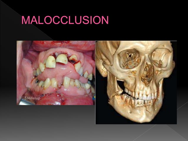 Lefort fractures | PPTX | Death, Injury, or Military Conflict ...