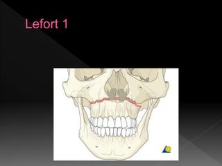 Lefort fractures | PPTX