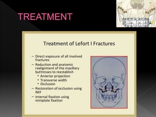 Lefort fractures | PPTX