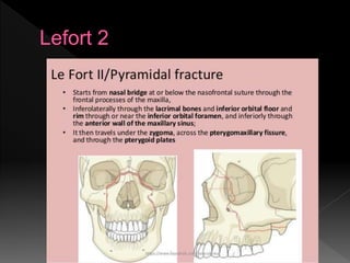 Lefort fractures | PPTX | Death, Injury, or Military Conflict ...