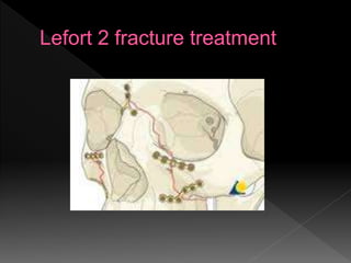 Lefort fractures | PPTX