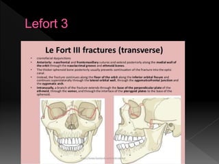 Lefort fractures | PPTX