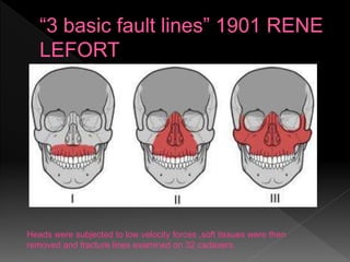 Lefort fractures | PPTX