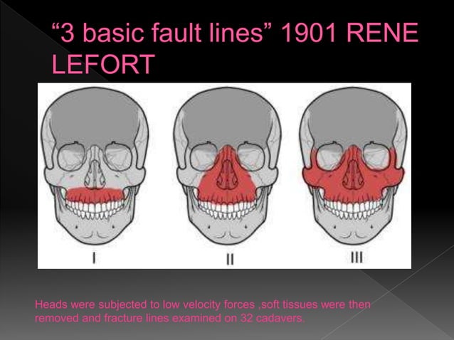 Lefort fractures | PPTX | Death, Injury, or Military Conflict ...