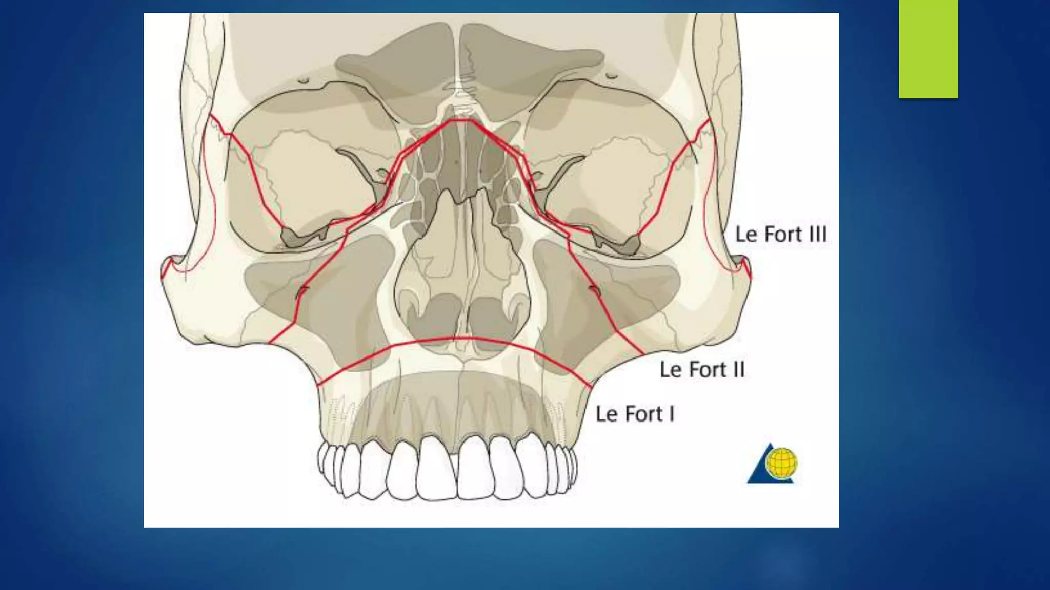 Lefort fractures | PPT