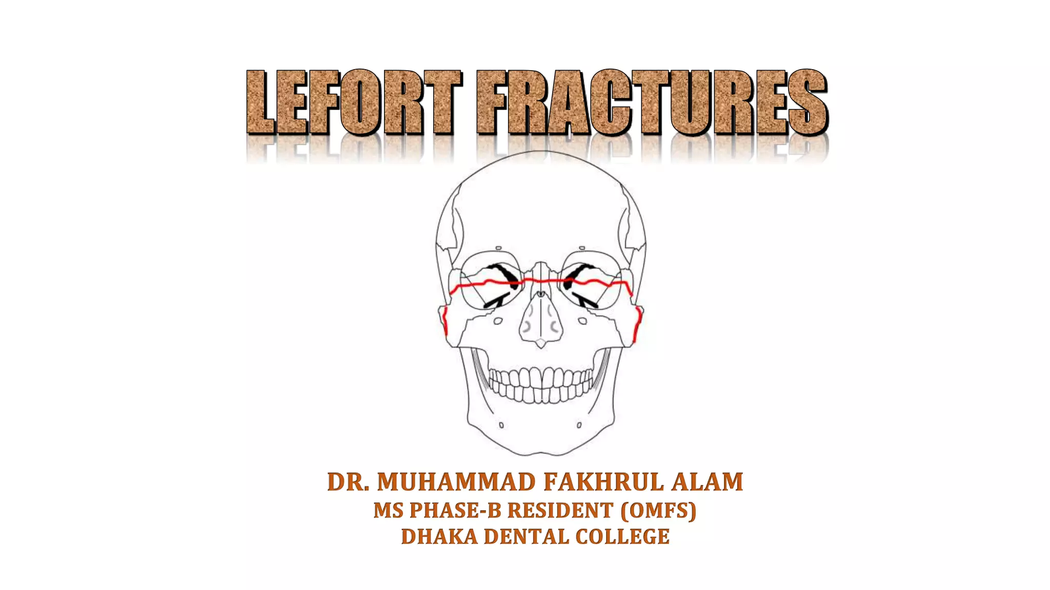 LEFORT FRACTURES.pptx