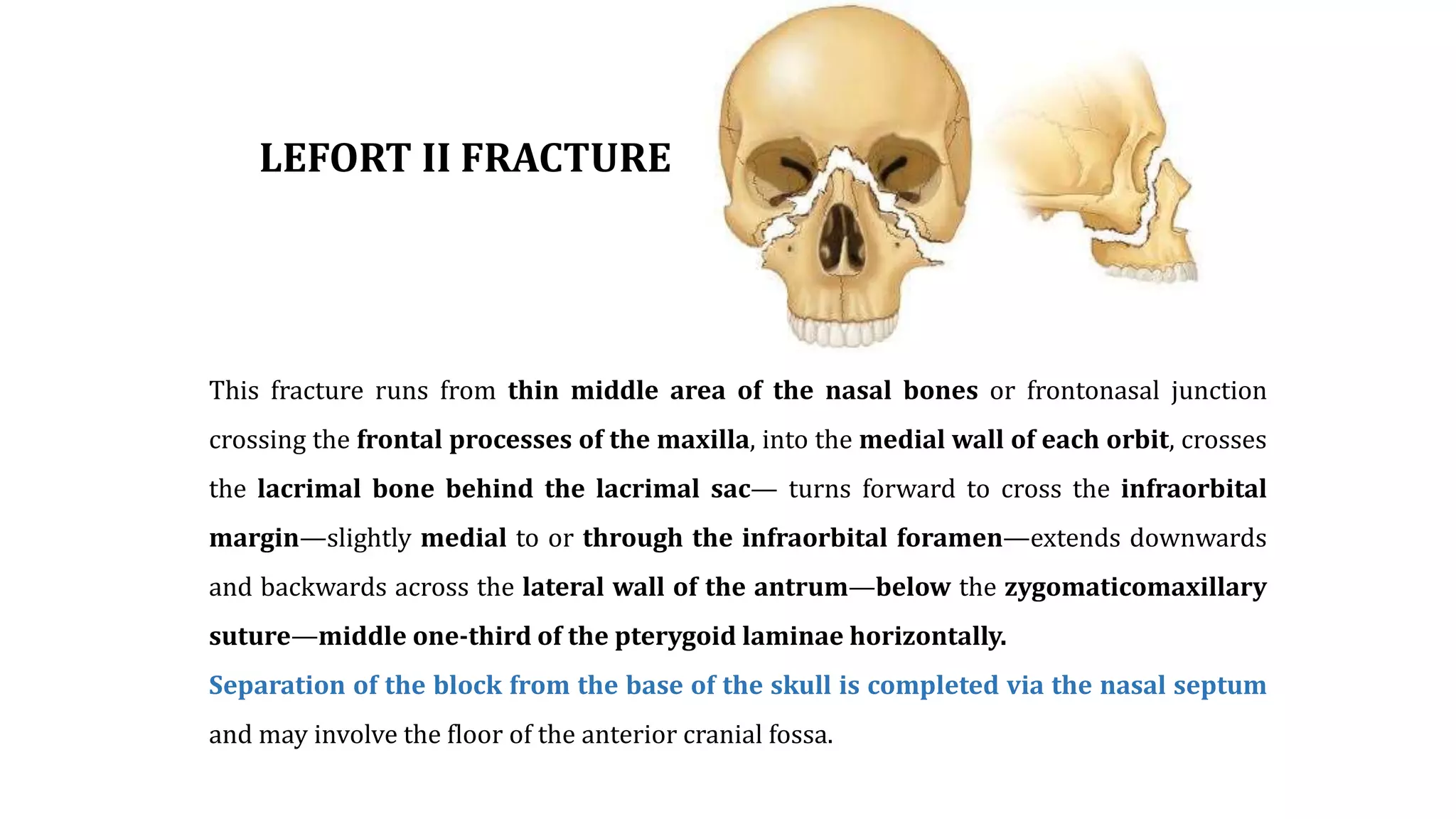 LEFORT FRACTURES.pptx
